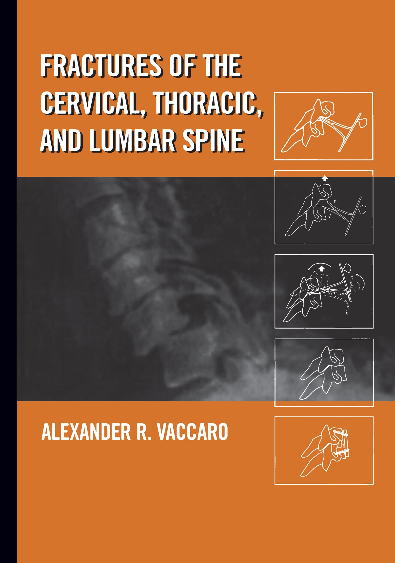 Fractures of the Cervical, Thoracic, and Lumbar Spine de non renseigné ...