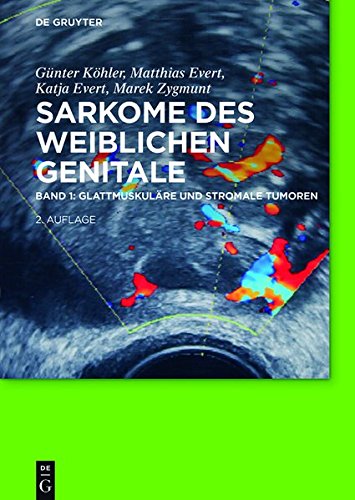 Sarkome des weiblichen Genitale: Glattmuskuläre und stromale Tumoren ...